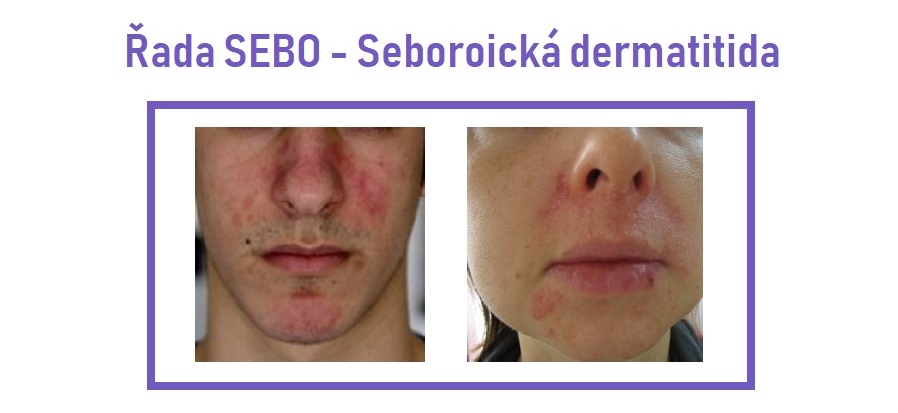 SEBO SEBORIOCKÁ DERMATITIDA - AHAVA® Dovozce do ČR